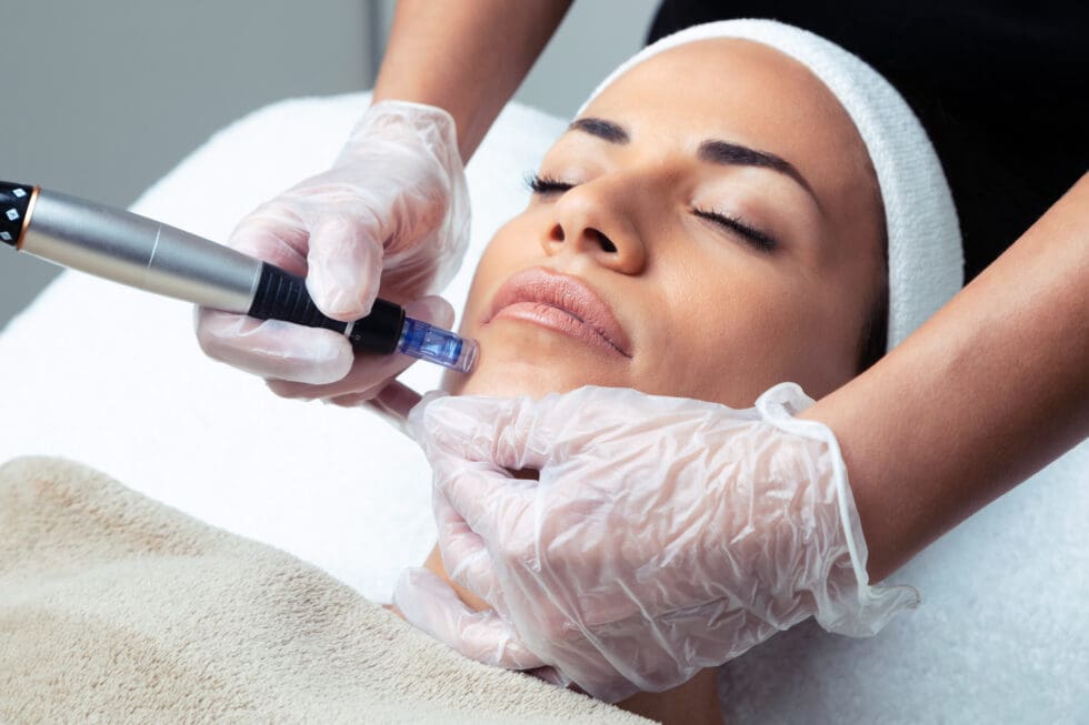 Microneedling | Graceful Glow